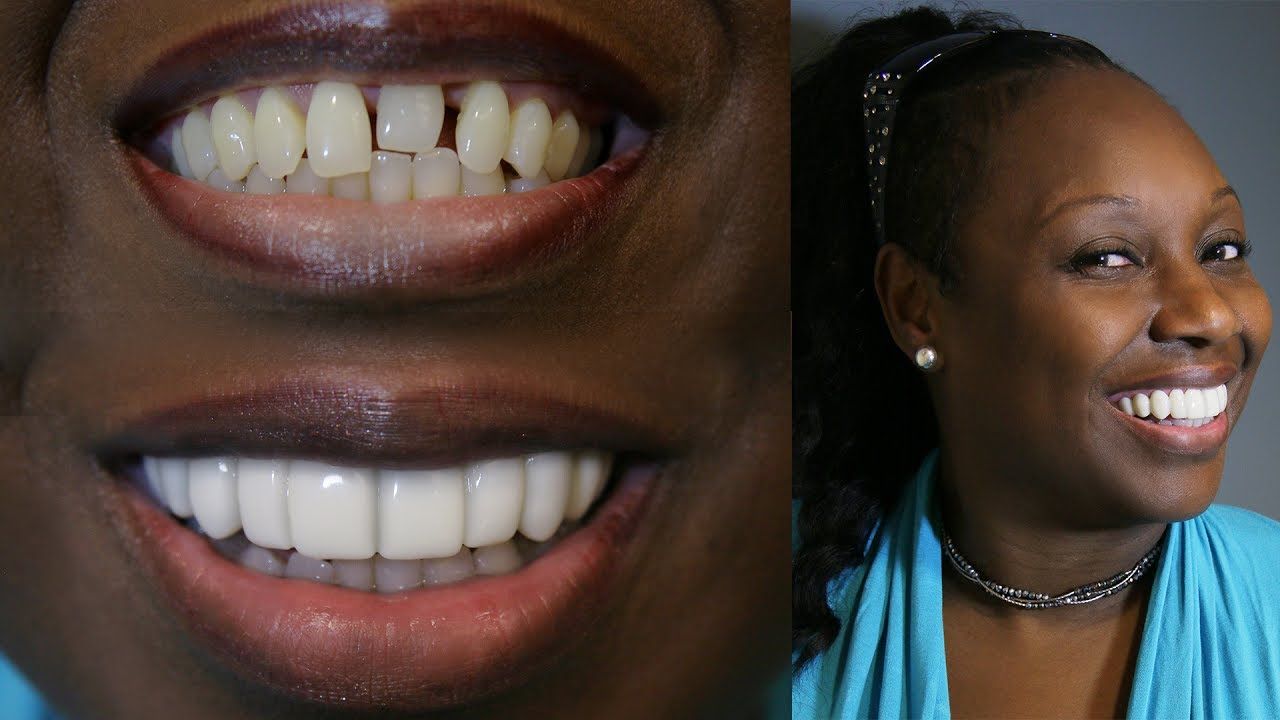 Change Your Smile, Change Your Life! Brighter Image Lab Providing Life ...